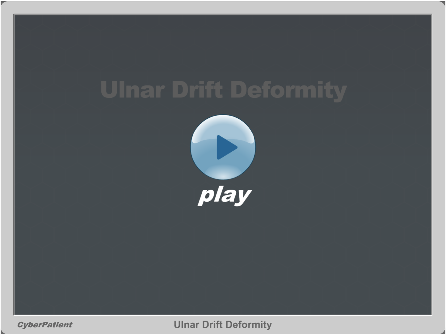 Ulnar Drift Deformity In Rheumatoid Arthritis – Educational Resources