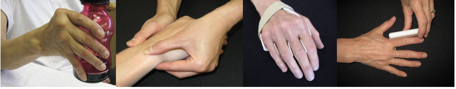 Ulnar Drift Deformity In Rheumatoid Arthritis – Educational Resources
