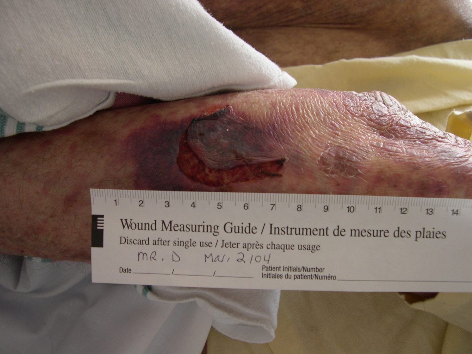 Wound Prevention – Educational Resources